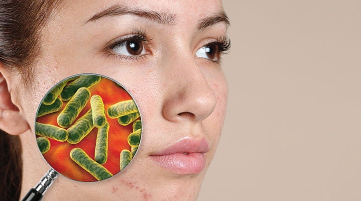 An Upside to Acne | Biology Article for Students | Scholastic Science ...